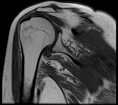 Musculoskeletal MRI | Muscles & Tendons MRI | AffordableMRI Twin Cities MN